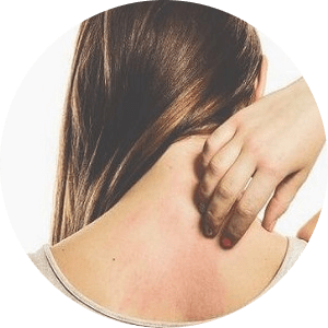 Łupież pstry – objawy, które warto znać - DERM.COM.pl